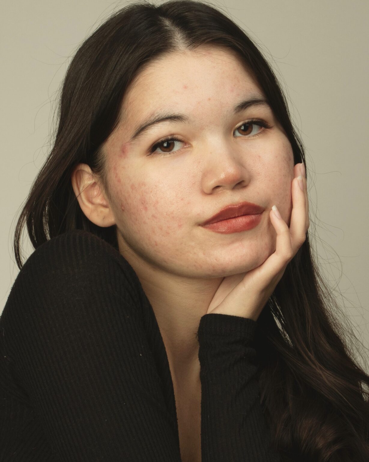 Acne Appreciation: Ariel Markham’s Mission to Redefine Beauty – HARNESS